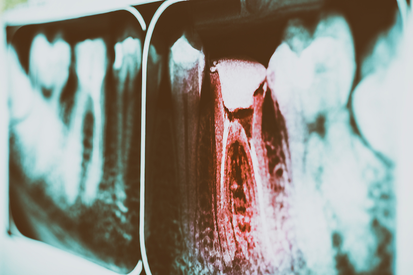 Could Root Canal Be Linked To Cancer Food Matters®